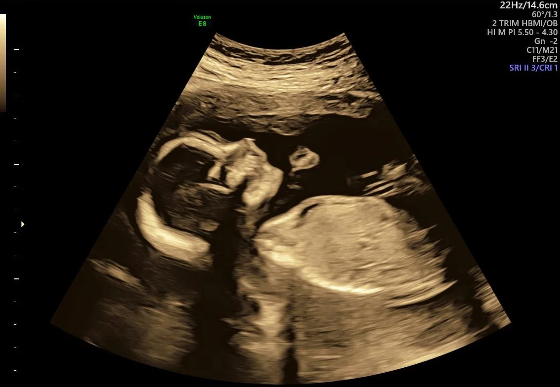 Anomaly Scan in Which Week of Pregnancy? Avoid These Common Timing Mistakes